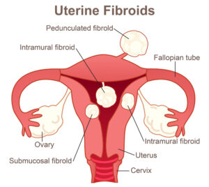 3 Unique Facts About Intramural Fibroids | Kansas University